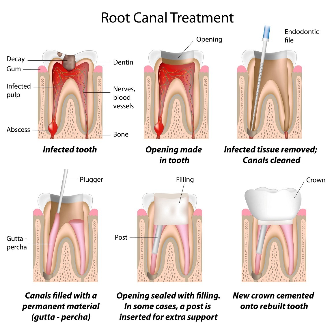 When Is A Root Canal Necessary Westside Family Dental When Is A Root Canal Necessary Westside Family Dental